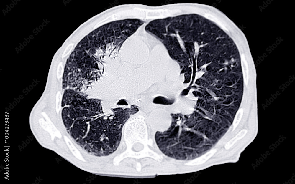 A CT scan of the chest, featuring the lungs and heart, used for ...