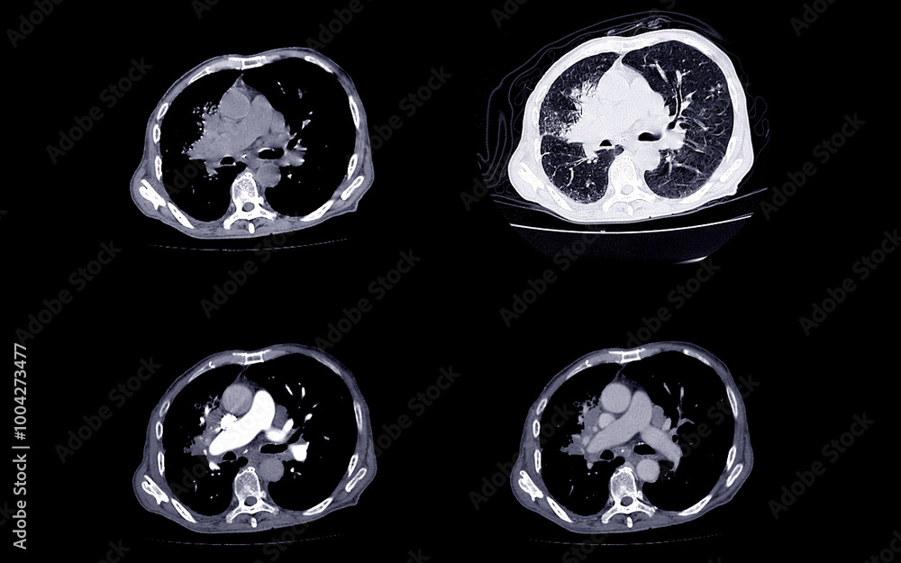 A CT scan of the chest showing multiple cross-sectional views ...