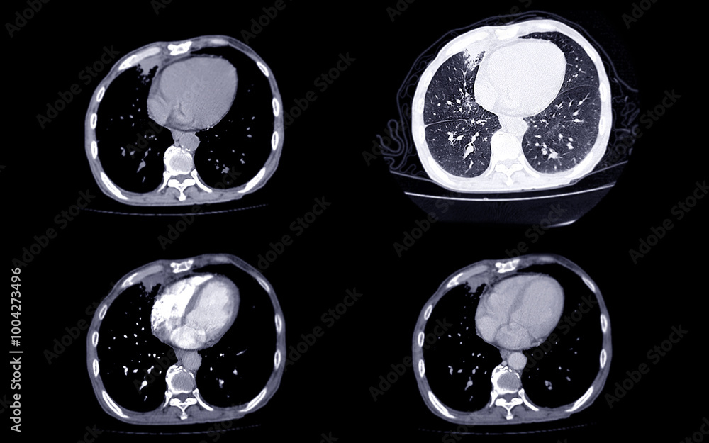 A CT scan of the chest showing multiple cross-sectional views ...