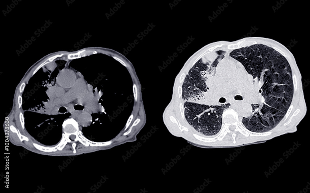 A CT scan of the chest showing multiple cross-sectional views ...