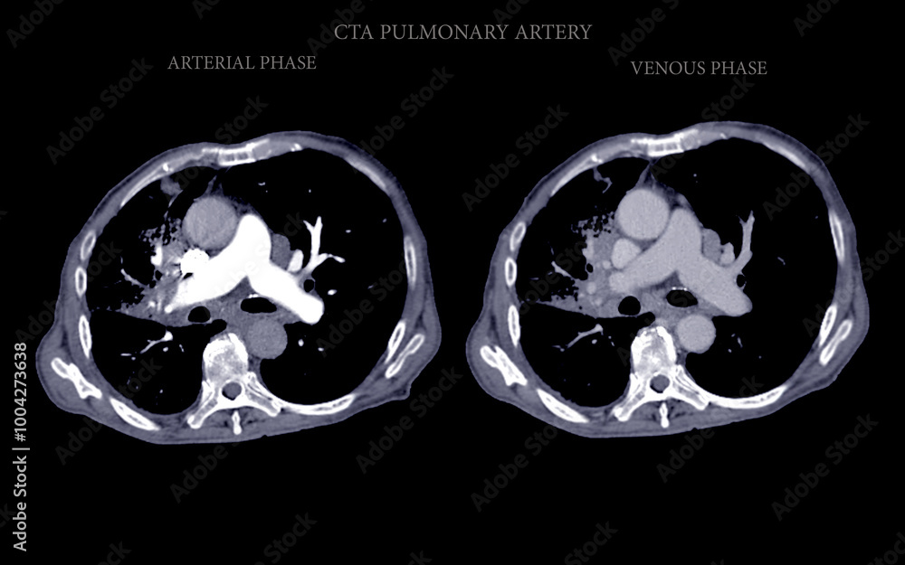 A CT scan of the chest showing multiple cross-sectional views ...