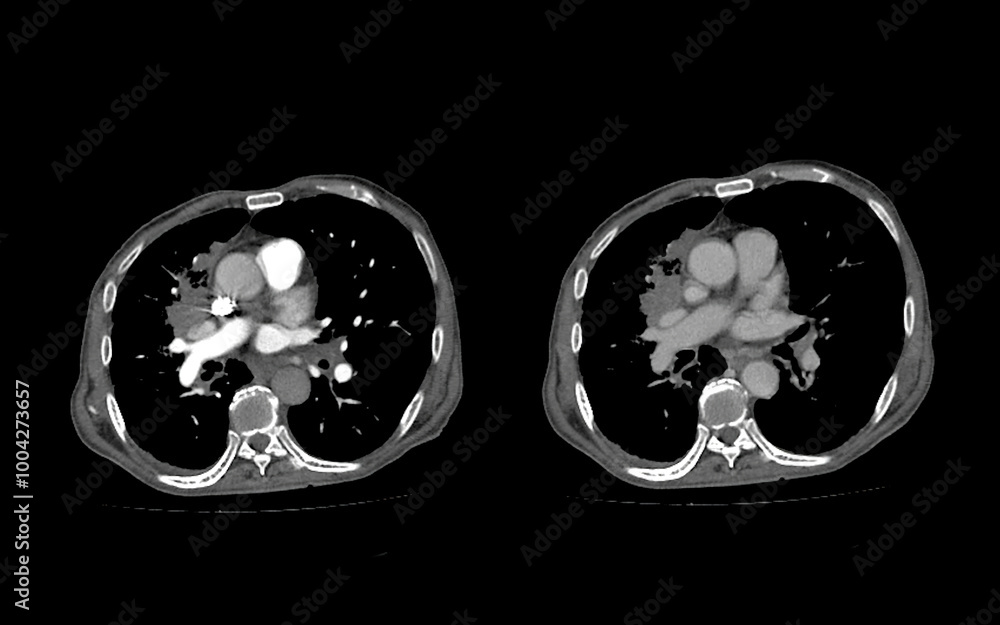 A CT scan of the chest showing multiple cross-sectional views ...