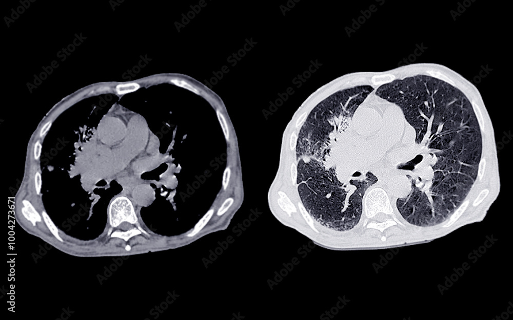 A CT scan of the chest showing multiple cross-sectional views ...
