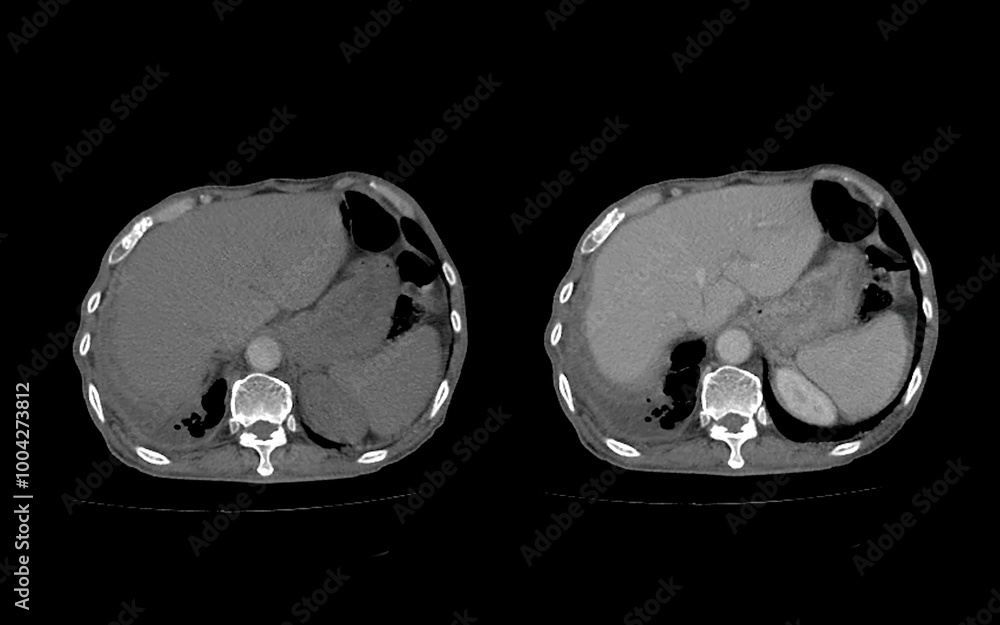 ภาพประกอบสต็อก A normal CT scan of the upper abdomen, showing clear and ...