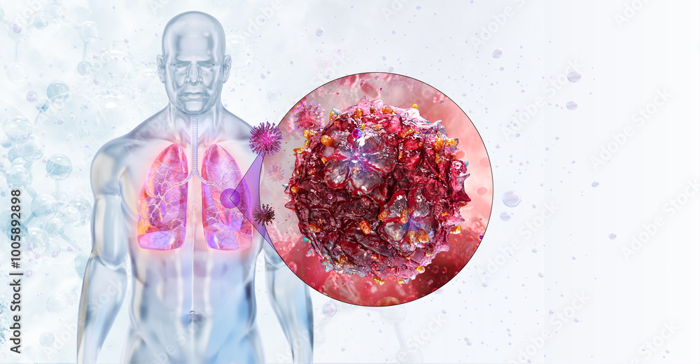 Lung infection caused by single stranded RNA rhinovirus. Human lungs ...