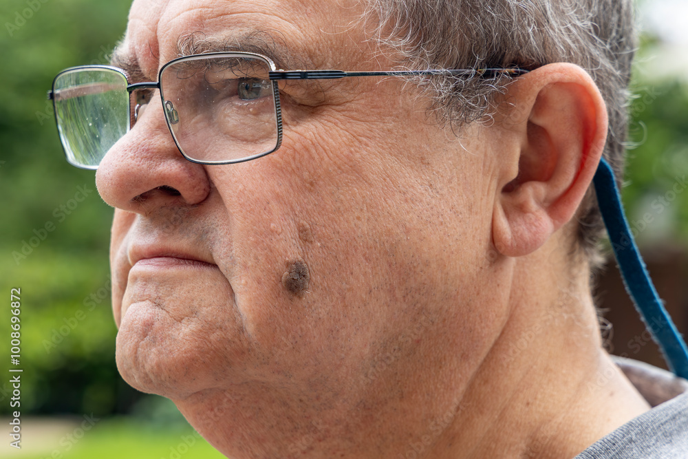 Brown Seborrheic Keratosis (Seborrhoeic wart, Basal cell papilloma ...