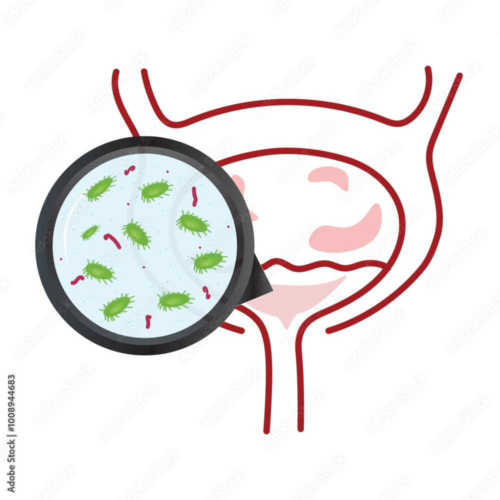Urinary tract infection(UTI) vector. Illustration of infect the urinary ...