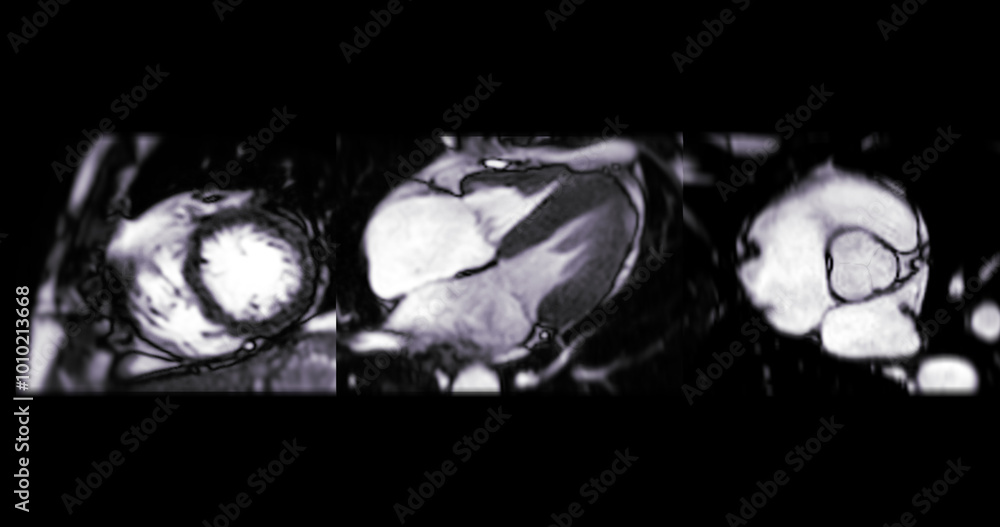 An MRI scan of the heart showing detailed cross-sectional anatomy, used ...