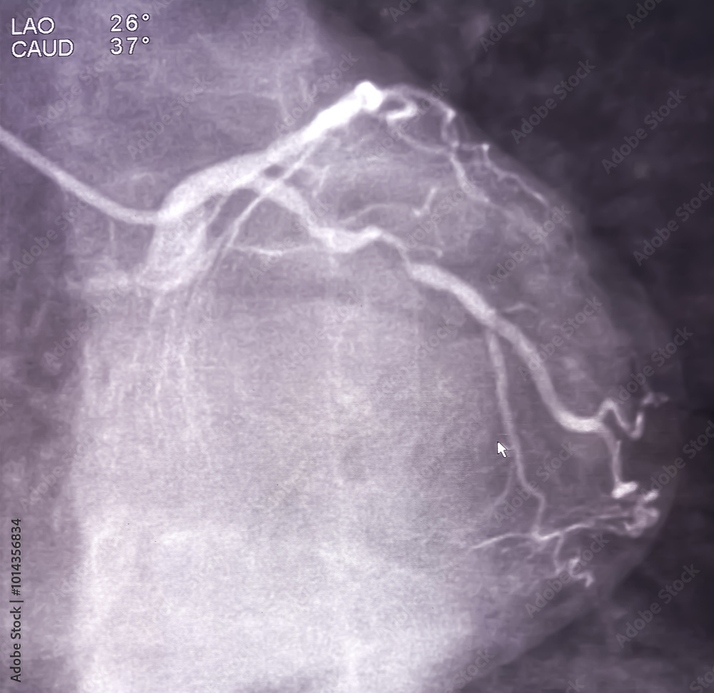 Coronary angiogram of left coronary artery during cardiac ...