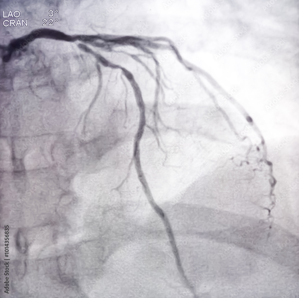 Coronary angiogram of left coronary artery during cardiac ...
