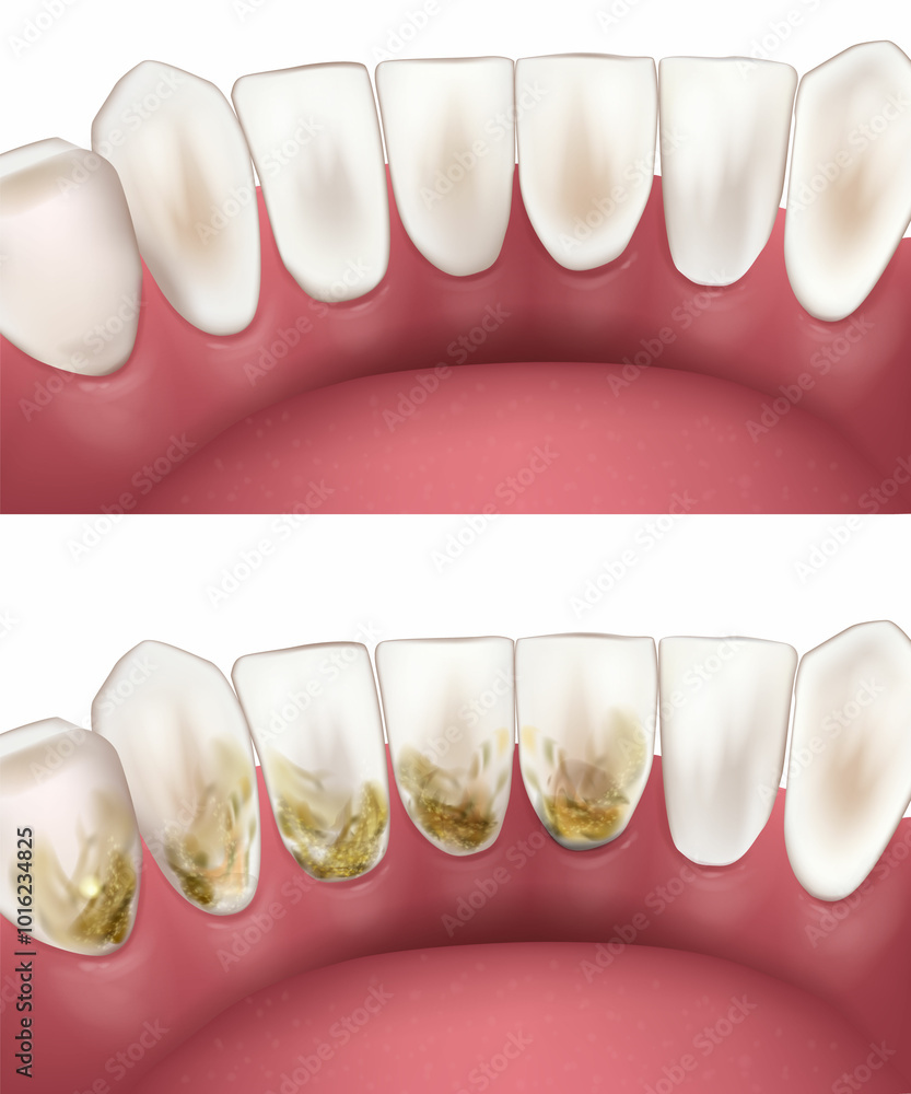 Deep Teeth Cleaning. Before and After. Teeth whitening concept ...