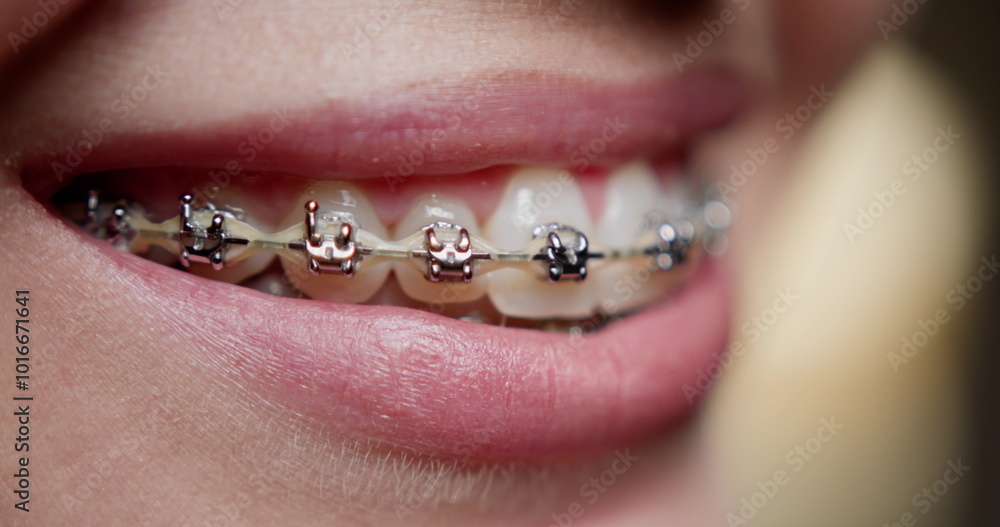 Metal brackets on teeth and importance of maintaining oral care with ...