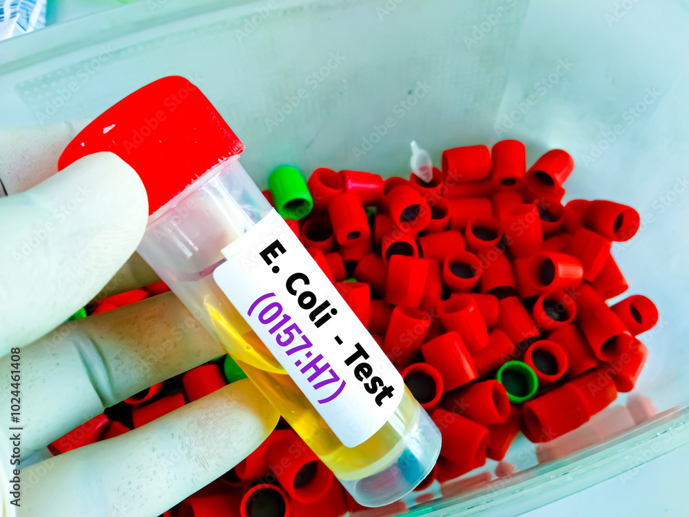 Urine sample for E. coli O157:H7 test. Serotype of Escherichia coli ...