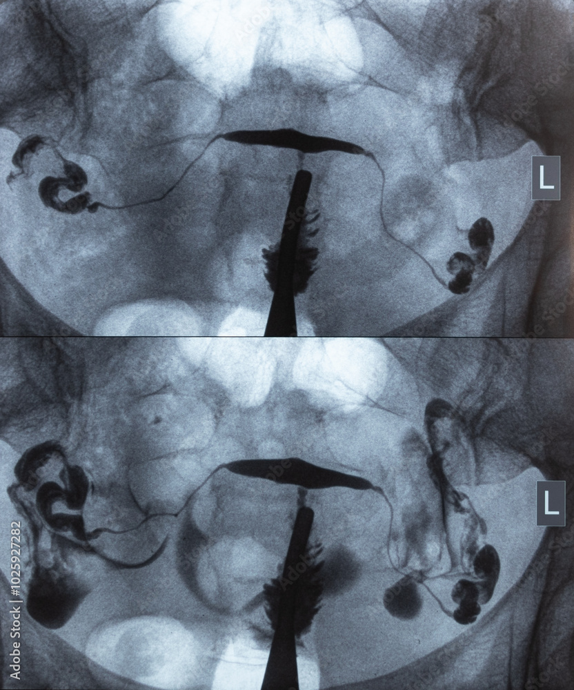 X-ray image of Hysterosalpingography (HSG). MRI with contrast agent ...