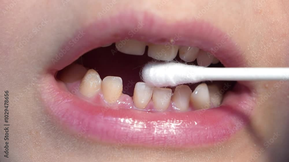 Baby teeth - first set of teeth in humans. Front incisors, on lower jaw ...