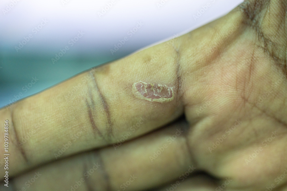 Wound and Scar on different parts of the body, Caused by an accident ...