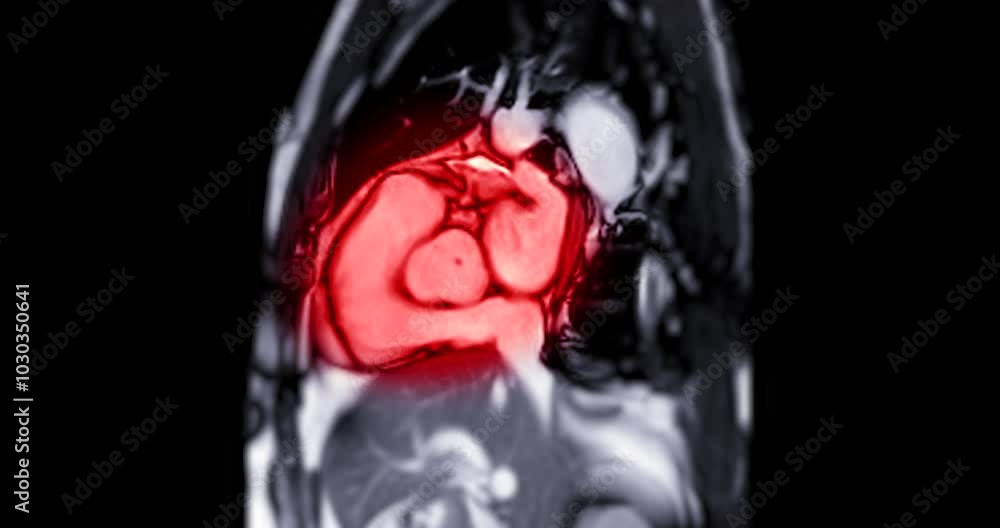 Real-time MRI footage of a healthy human heart, showing clear details ...