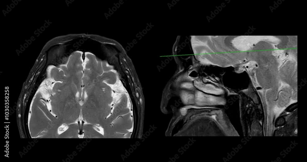 High-Resolution MRI Scan of Paranasal Sinuses for Medical Diagnosis and ...