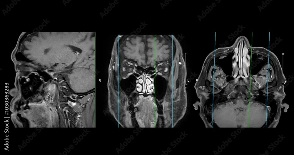 High-Resolution MRI Scan of Paranasal Sinuses for Medical Diagnosis and ...