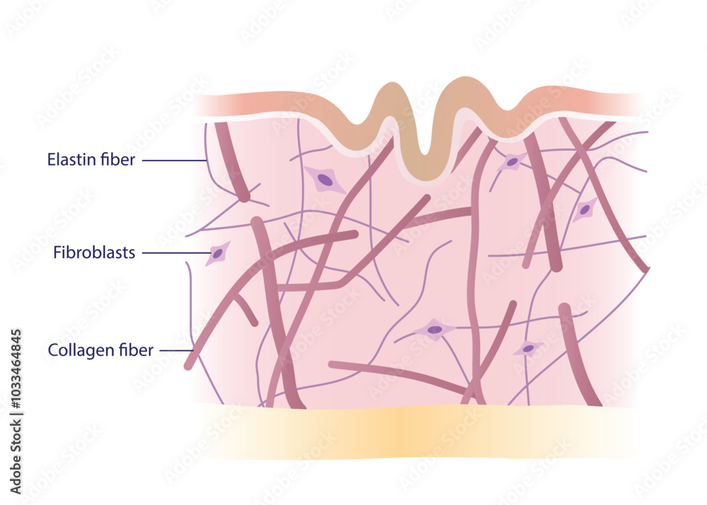 Cross section of skin layer with damaged collagen, elastin fibers and ...