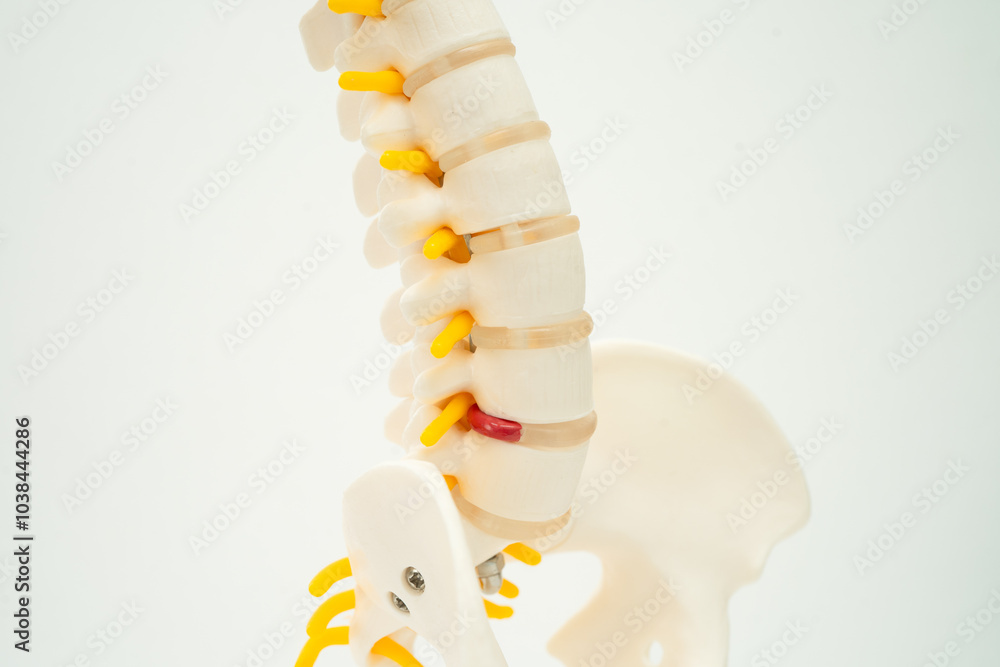 Plakát Spinal nerve and bone, Lumbar spine displaced herniated disc ...