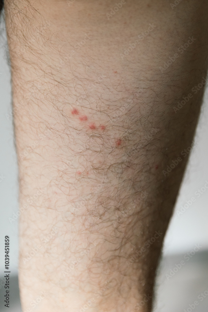 Skin irritation with red marks on a lower leg during daylight, possibly ...