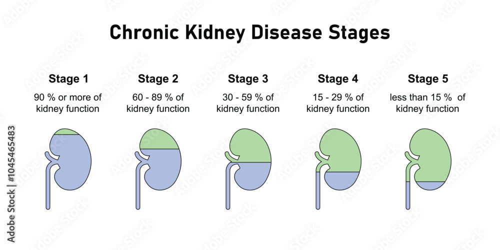 Chronic Kidney Disease (CKD) Stages Scientific Design. Vector ...