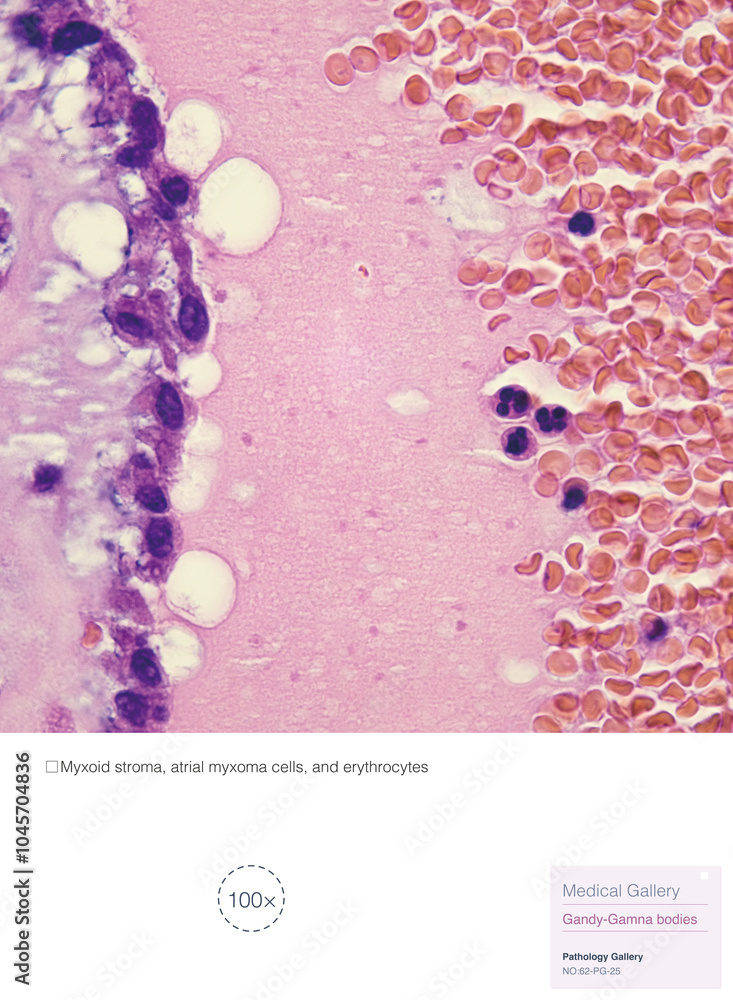 This photo shows the pink myxoid stroma of an atrial myxoma, with cords ...