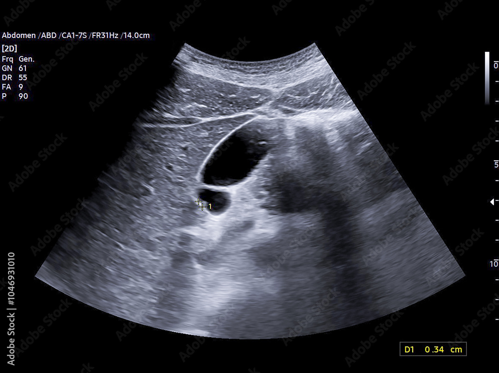 Ultrasound scan of the upper abdominal region showing several small ...