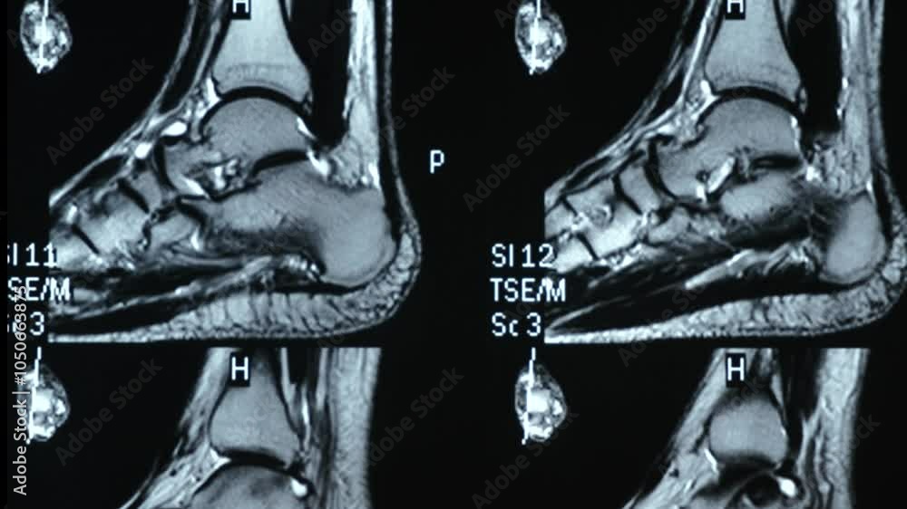 Vertical tracking of MRI Magnetic Resonance scan image of the left foot ...