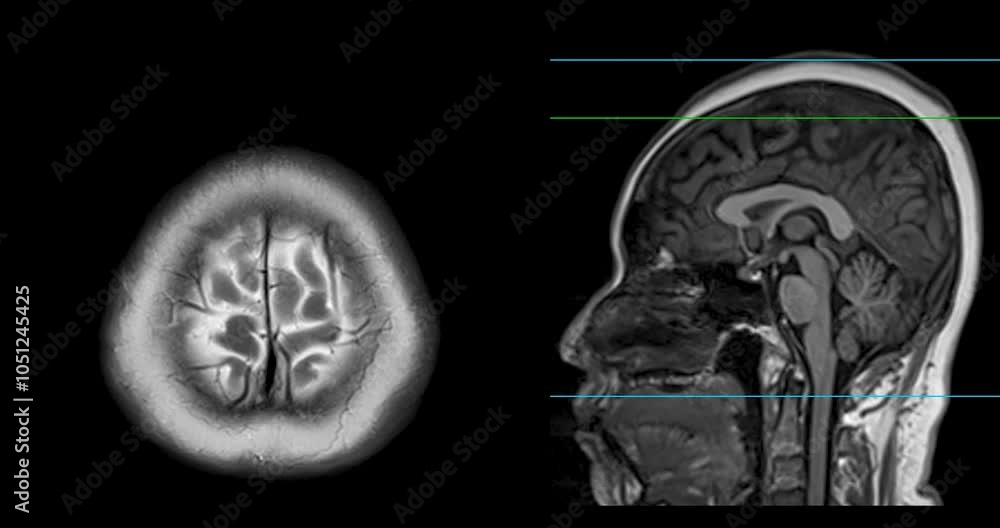 The MRI brain footage reveals areas of reduced blood flow, indicating ...