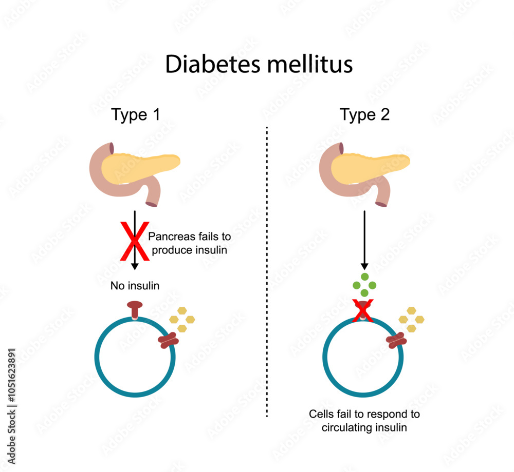 Diabetes mellitus type 1, pancreas's failure to produce enough insulin ...