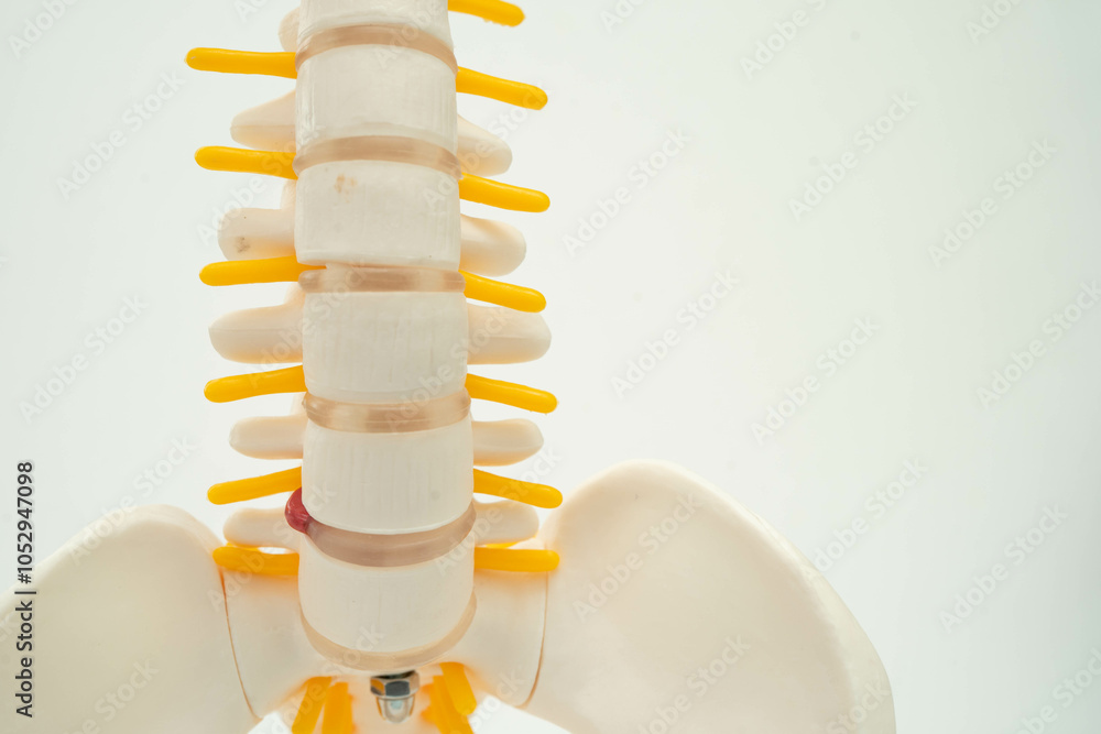 Fotografía Spinal nerve and bone, Lumbar spine displaced herniated disc ...