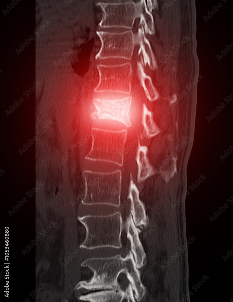Illustrazione Stock Lumbar Spine CT Imaging with L1 Compression ...
