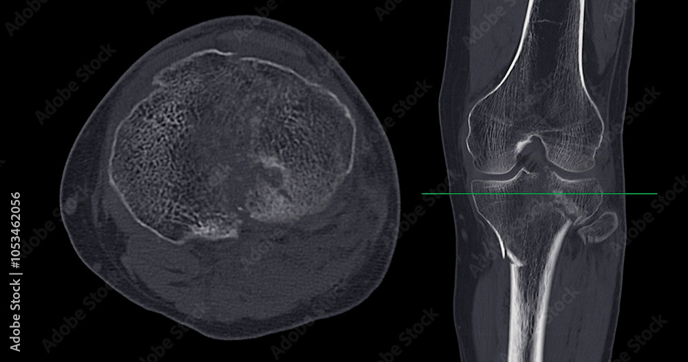 CT Imaging of Tibia and Fibula Fracture in Trauma Case .A detailed CT ...