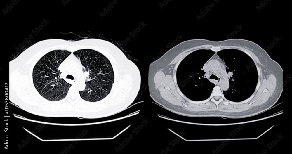 A CT scan of the chest, featuring the lungs and heart, used for ...