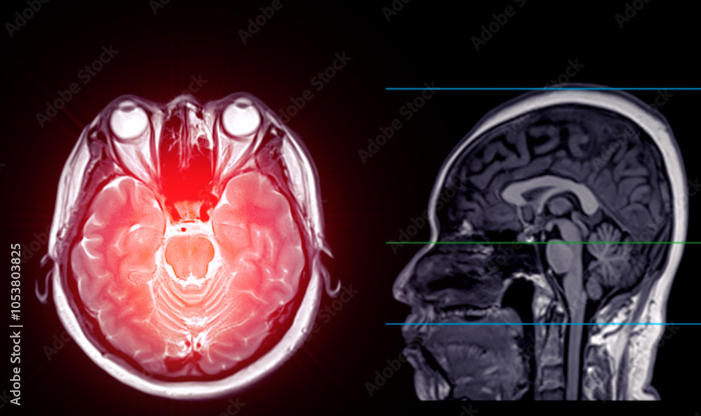 A normal contrast-enhanced MRI scan of the brain showing clear ...
