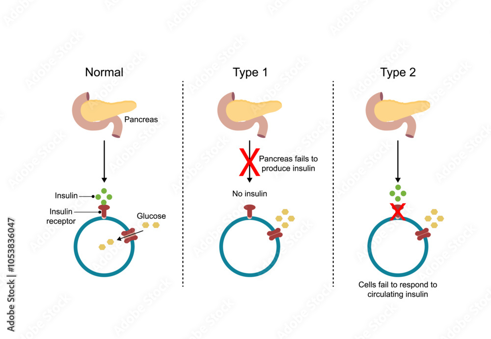Diabetes mellitus type 1, pancreas's failure to produce enough insulin ...