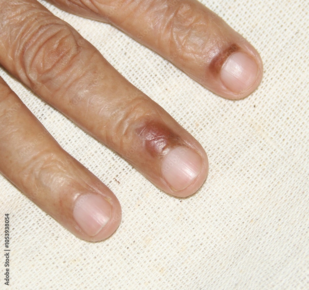 Hot oil splashed on the skin and caused a painful burn. The skin turned ...