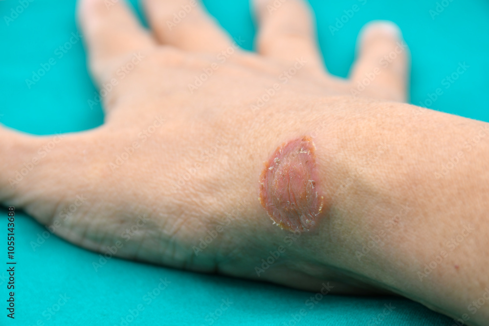Poster Microsporum canis lesion, a fungus infections on human skin ...