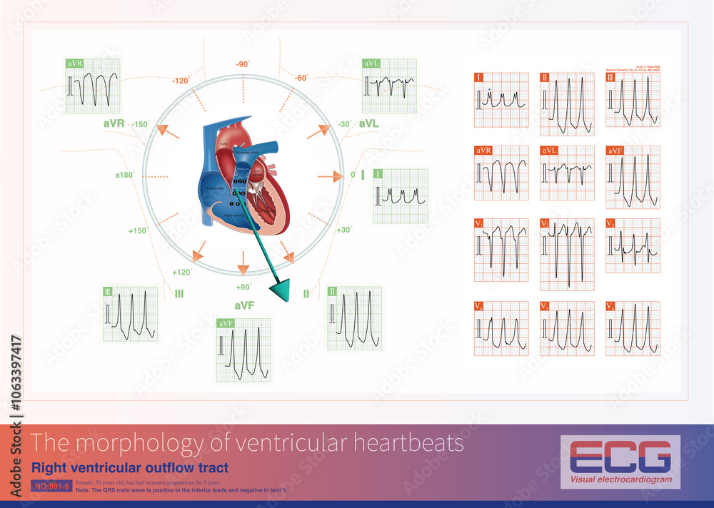 Idiopathic ventricular tachycardia originating from the right ...