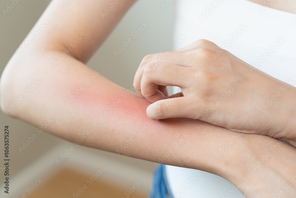 Póster Dermatology, asian young woman reaction from atopic, insect ...