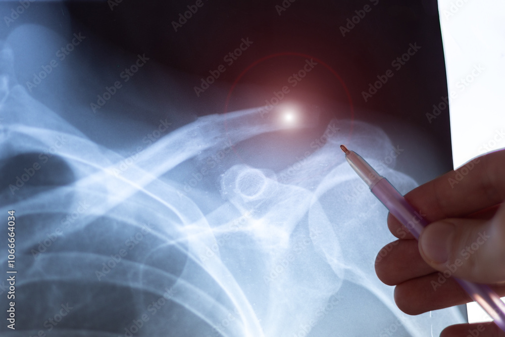 Poster Doctor examining X-ray scan of Dislocation of the acromial end ...