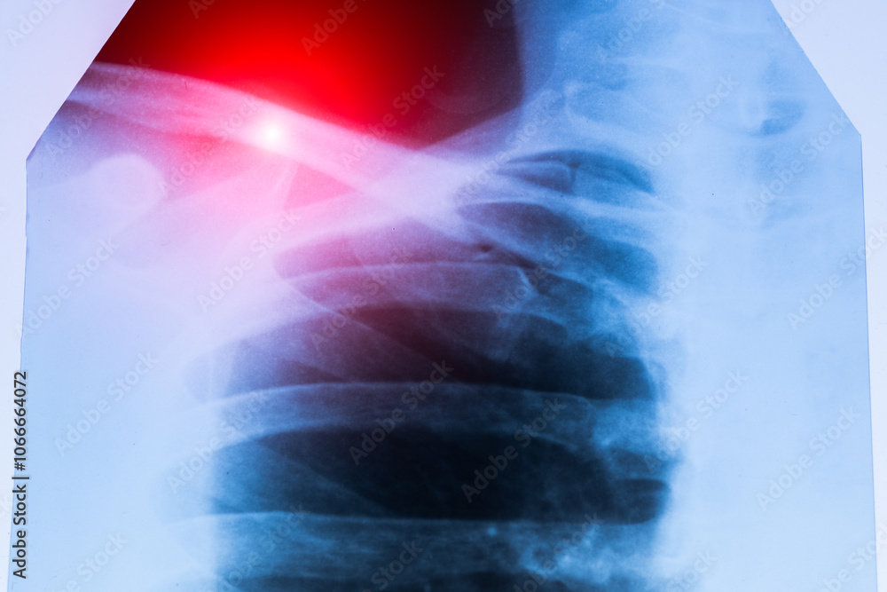 Poster X-ray scan of Dislocation of the acromial end of the clavicle ...