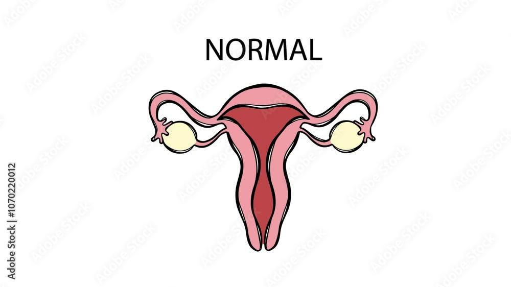 ENDOMETRIOSIS NORMAL FEMALE VIDEO Reproductive System Cells Similar To ...