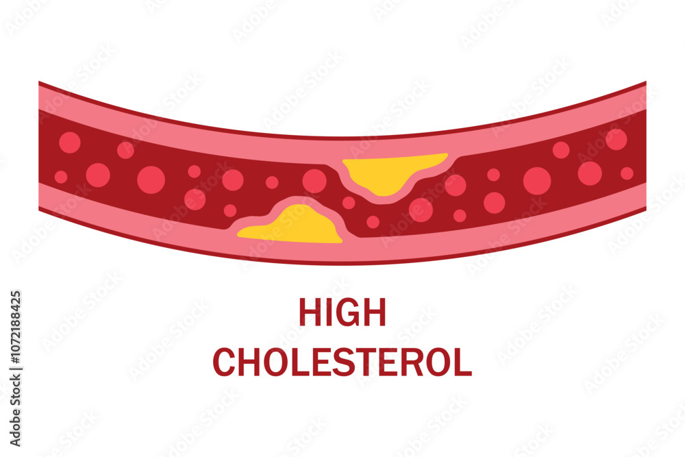High blood cholesterol colorful icon with a arteriosclerosis risk ...