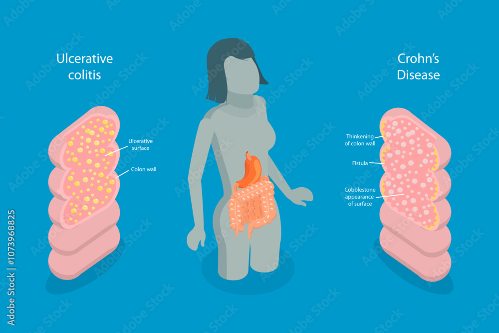 3D Isometric Flat Vector Illustration of IBD, Educational Diagram for ...