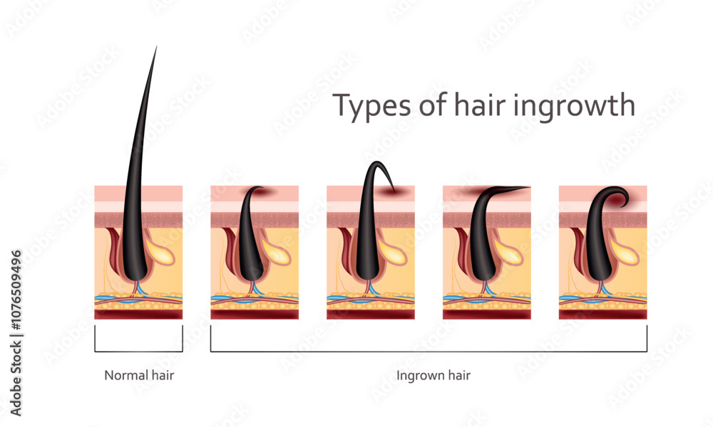 Types of ingrown hair, skin and ingrown hair. Realistic vector Stock ...