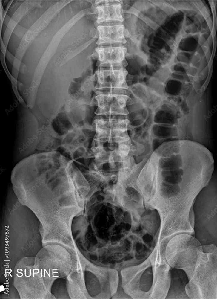 Poster X-Ray Imaging of Bowel Blockage and Intestinal Obstruction ...