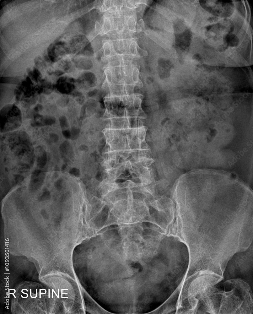 Photo & Art Print Abdomen supine radiograph for bowel condition ...